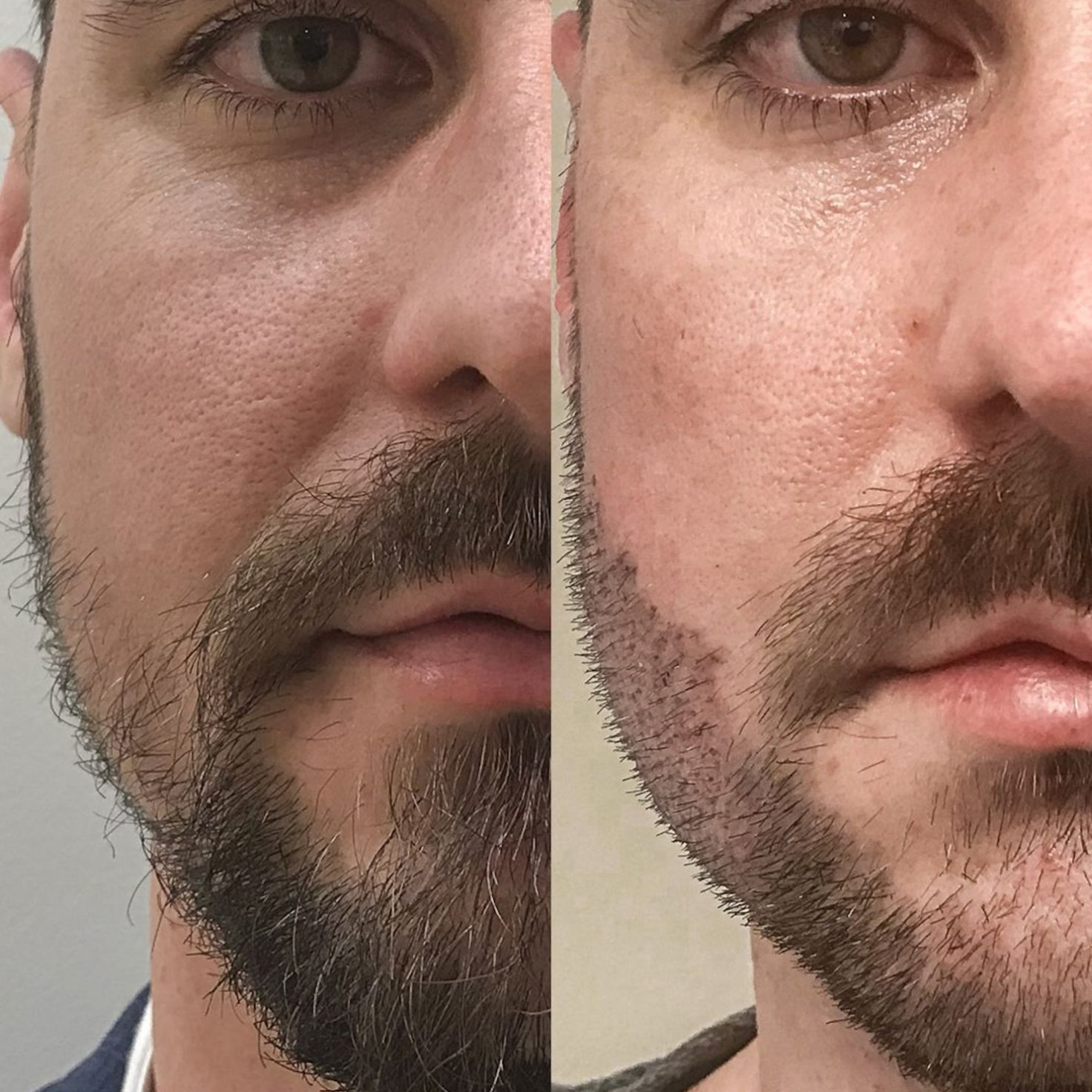 Baby-Faced men opt for Beard Transplants | CrowdInk